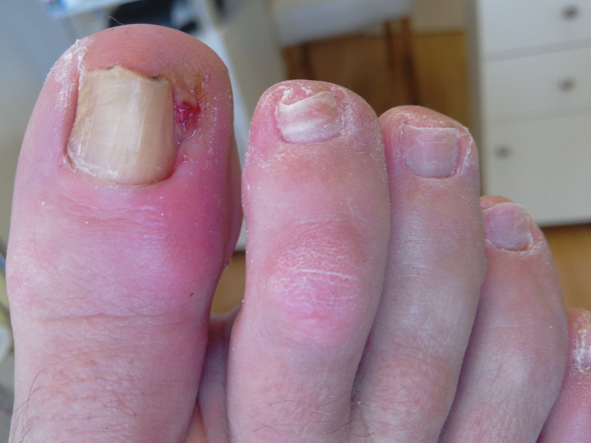 Zarostlý nehet :: PediPro I Protože u nohou to začíná